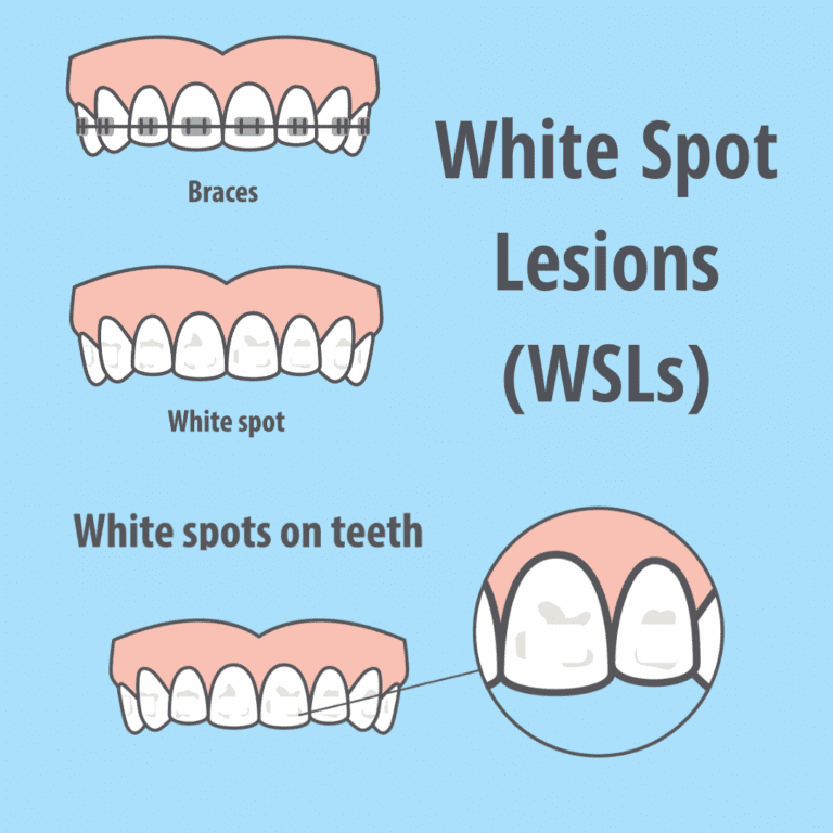 Treating White Spot Lesions 8608